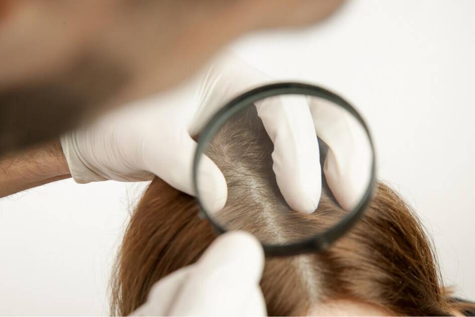 The ultimate guide to scalp psoriasis
